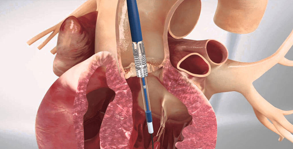 Heart Valve Replacement Surgery: What It Is and How It Saves Lives